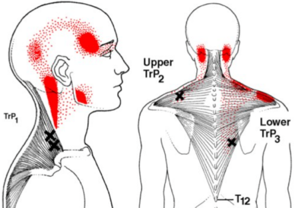 Κεφαλαλγίες. A pain in the neck